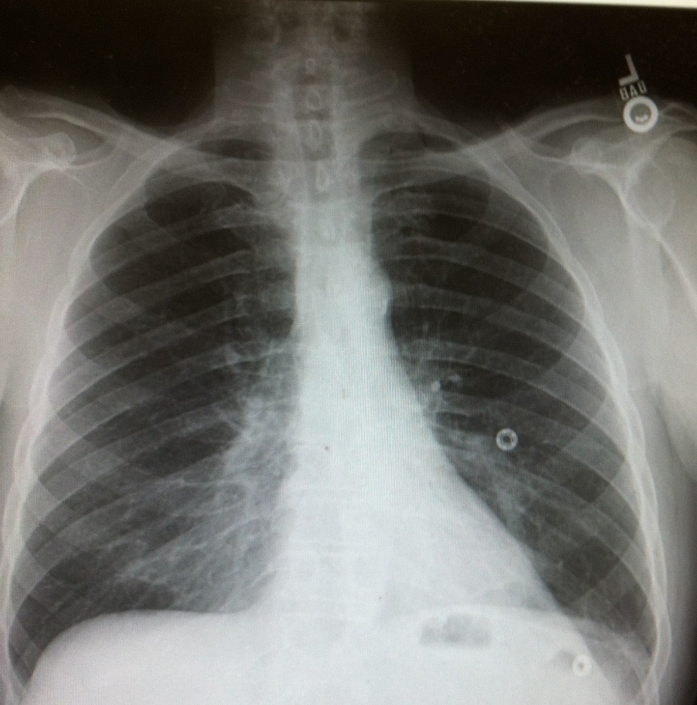 Case Presentation Cardiac Complications After Lung Surgery STS Case Presentation Cardiac Complications After Lung Surgery STS